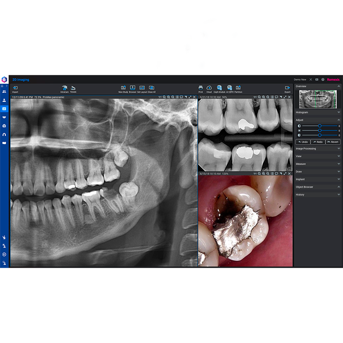 Romexis 3D Implant Guide - Guias Cirúrgicas de Forma Fácil