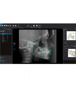 Romexis Cephalometric Analysis - Tratamentos Ortodônticos